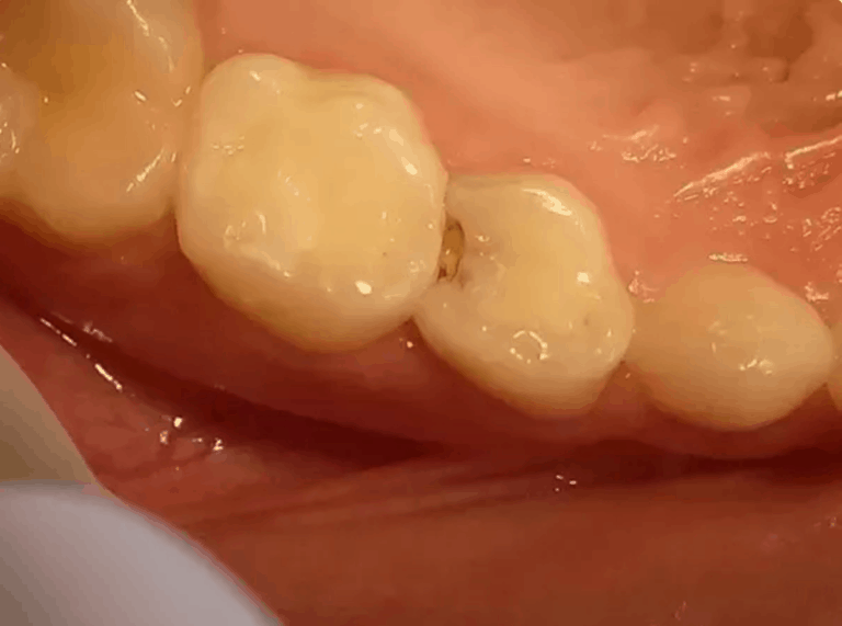 What does a cavity look like? Identifying tooth decay