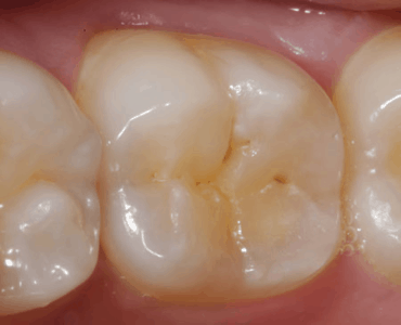 What does a cavity look like? Identifying tooth decay